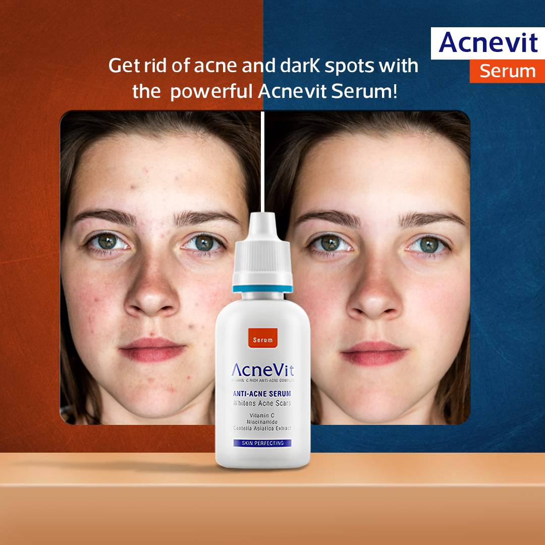 Achieve Clearer Skin with Acnevit Serum for Acne